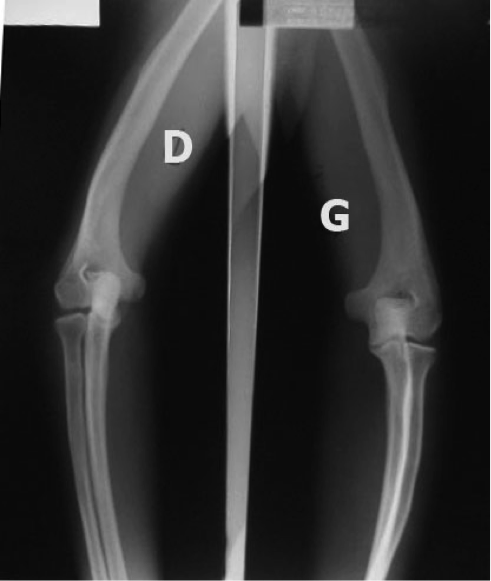 L’osteogenese imparfaite : à propos de deux cas Figure 3