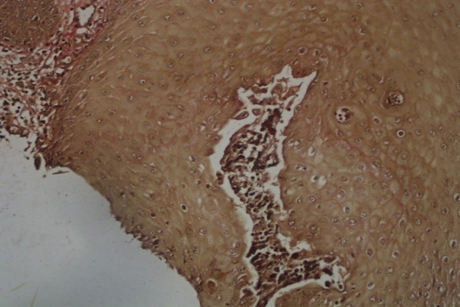 Elastosis Perforans Serpiginosum Clinical Presentation