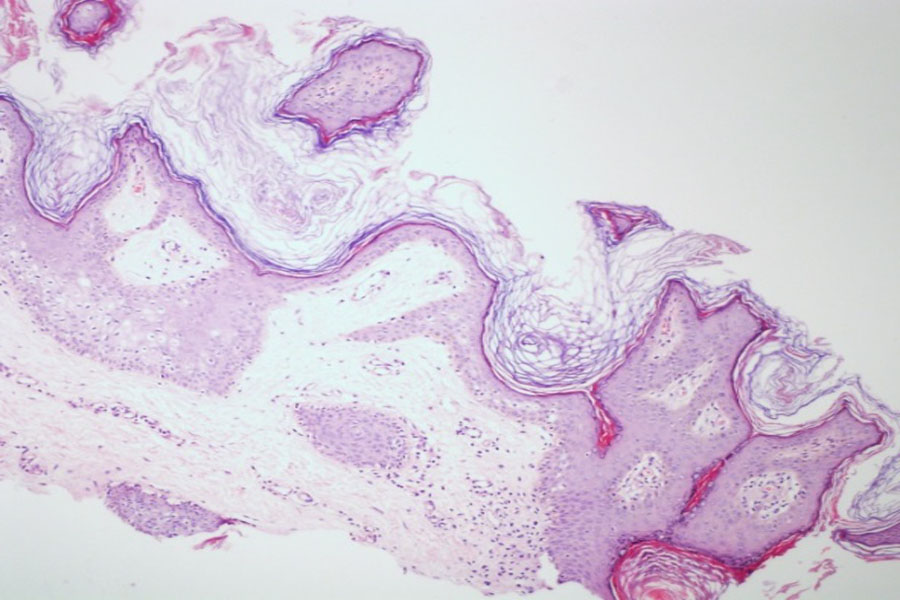 Elastosis Perforans Serpiginosum Clinical Presentation
