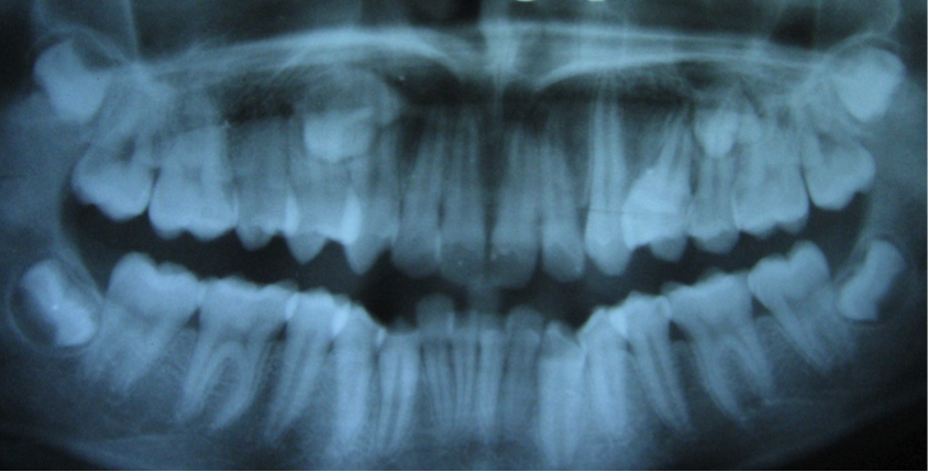 non-syndrome multiple supplemental supernumerary teeth